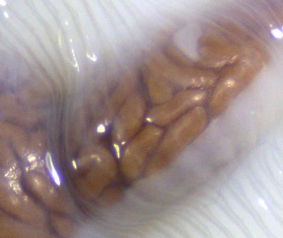 Überblick Pentastomiasis - Parasitus Ex e.V.